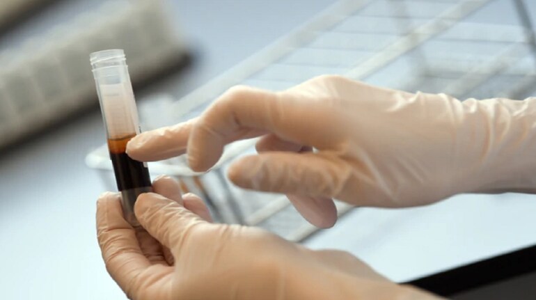 In a first in Kerala, Apheresis procedure used to administer plasma to ...