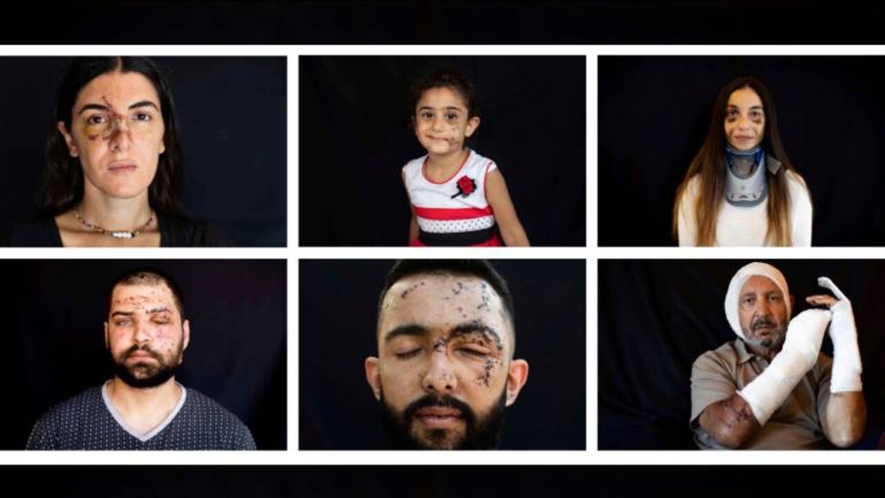 In pics | Scars of Beirut blast victims capture the horrific moment ...
