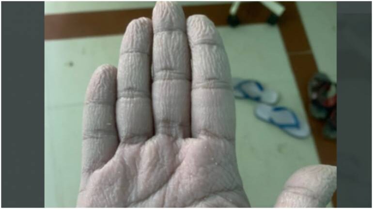 COVID-19: Twitter expresses gratitude as doctor shares picture of pruney fingers after using PPE kit
