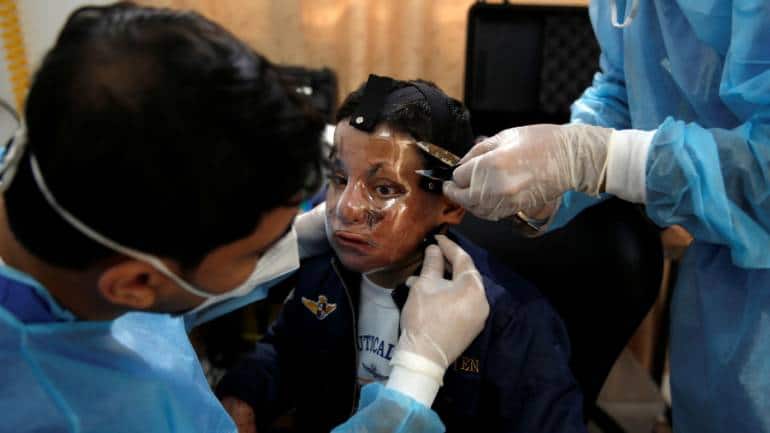 Gaza burn victims get 3D-printed face masks made close to home