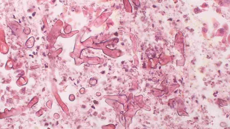 Mucormycosis can spread through air, won’t cause any problem if person ...