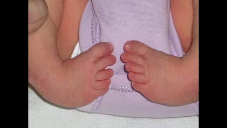 What is Arthrogryposis? Know all about the condition in the ...