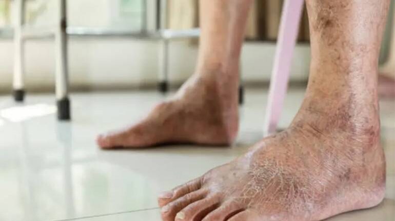 Can Diabetes Lead To Vascular Disease How To Prevent Vascular