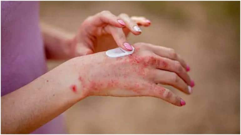 This 11-year-old aspiring dancer is allergic to her own sweat and tears ...