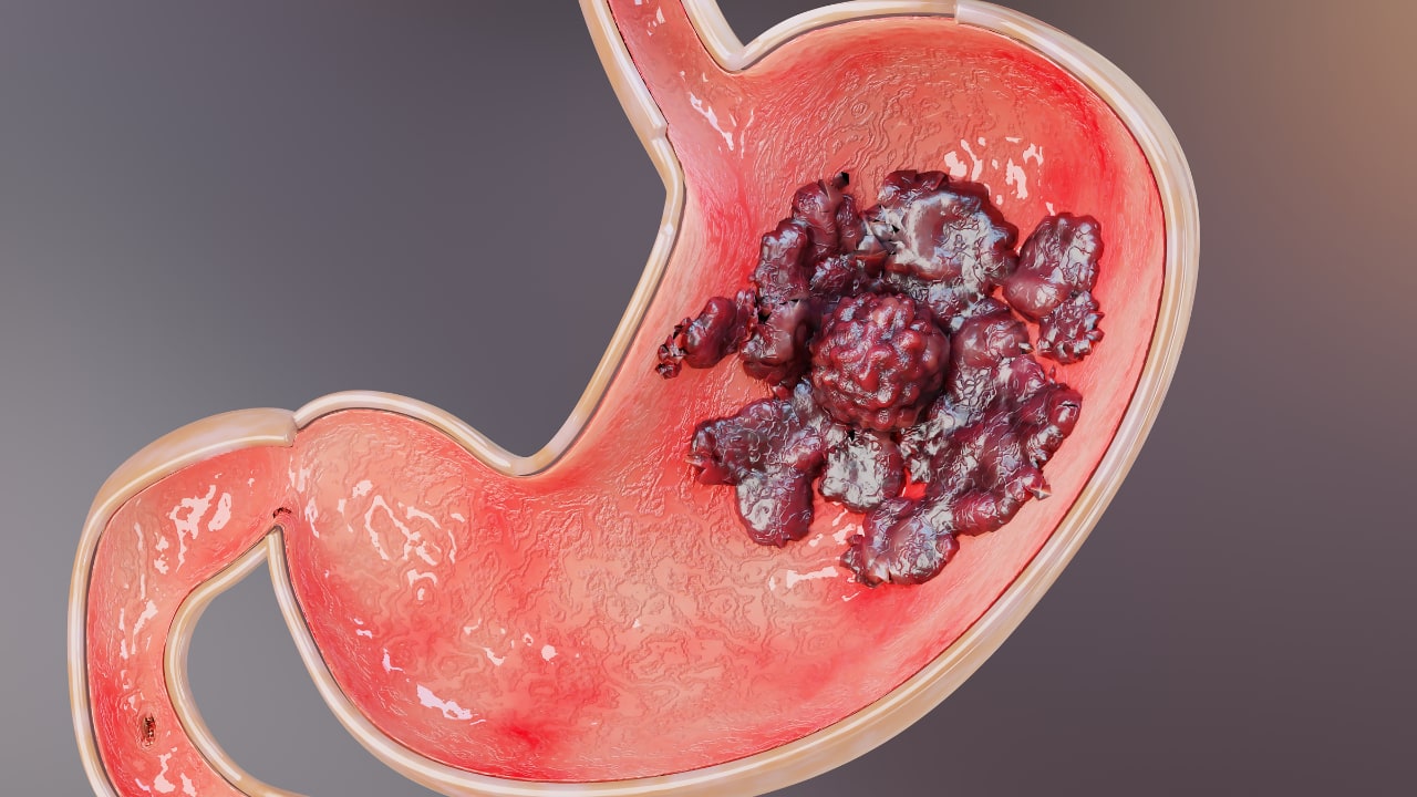 Peptic ulcer: 7 effective home remedies you must try to combat it