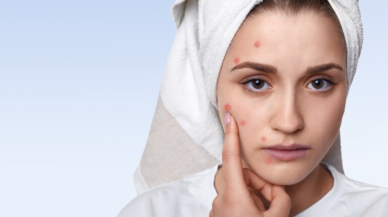 Stress: Acne breakouts, dullness and hair loss are signs your skin ...