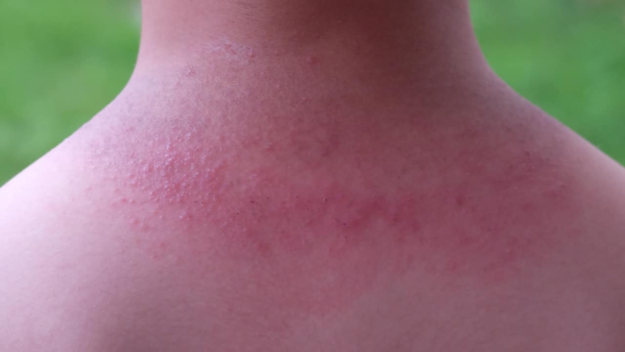 Home remedies for prickly heat: Use aloe vera gel, calamine solution to ...
