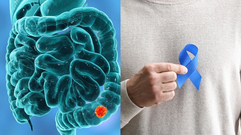 Symptoms of colon cancer: Fatigue, bleeding, weight loss are warning ...