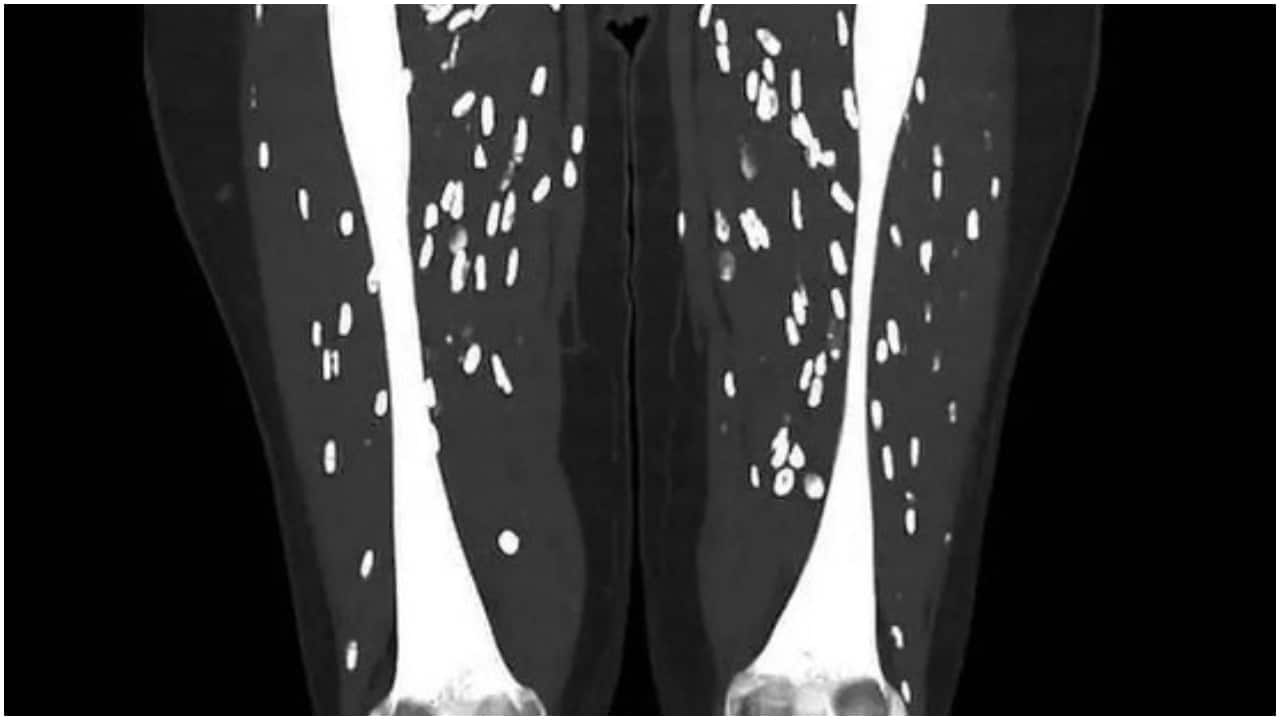 'Craziest CT scan': Patient's leg riddled with parasites after eating ...