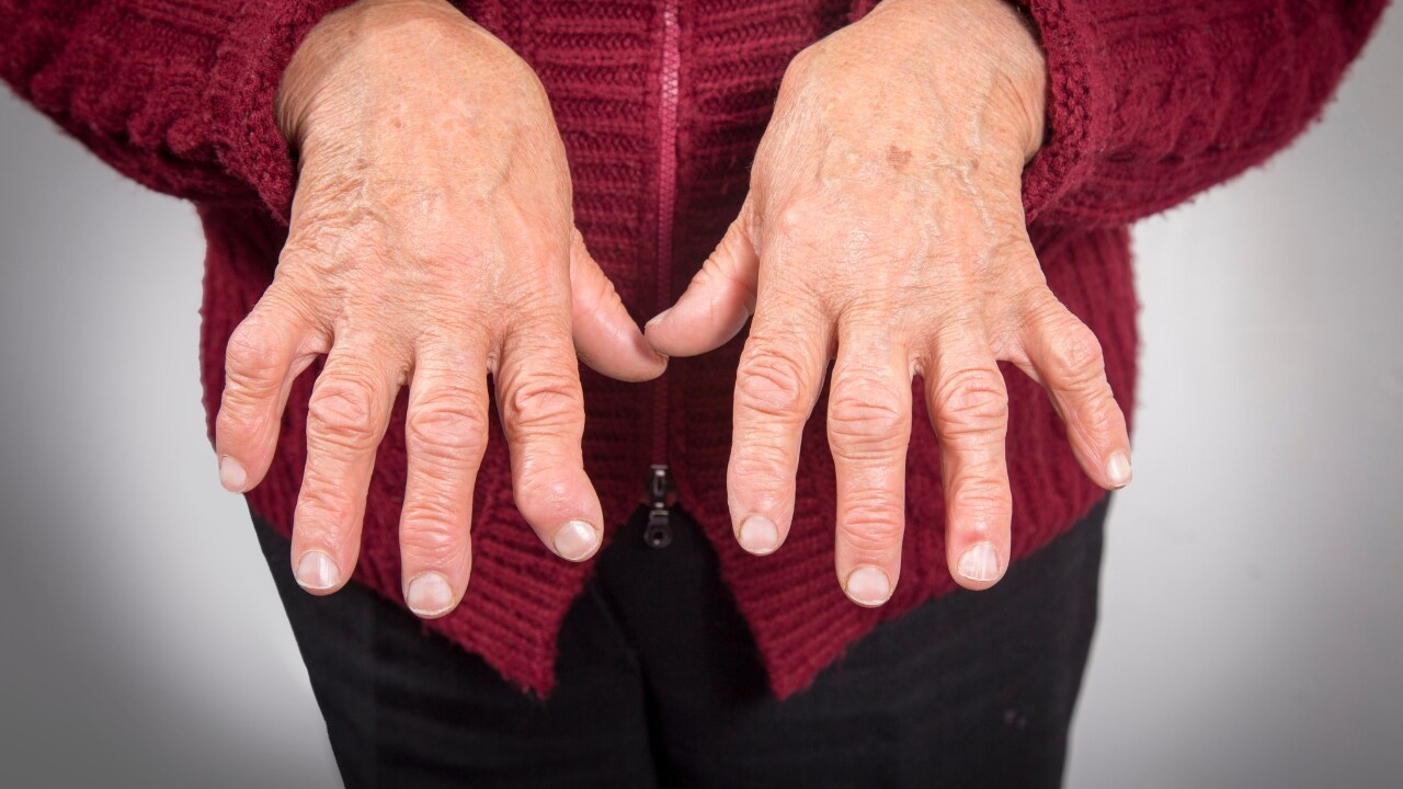 Rheumatoid Arthritis Hands How Do I Know If I Have Rheumatoid