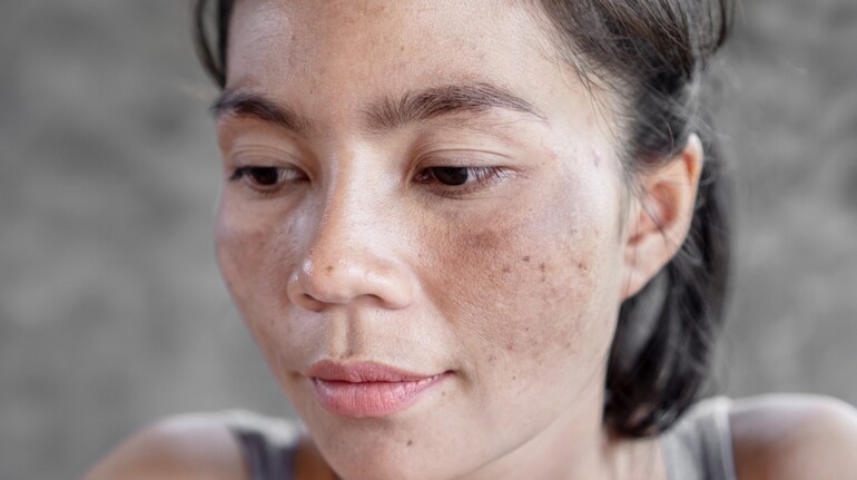 What is melasma, causes of this skin condition, expert tips to minimise ...