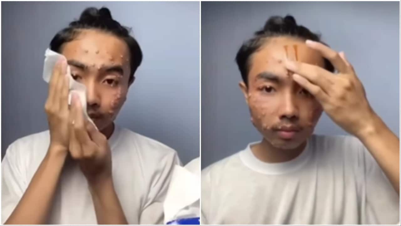 Man develops skin infection on face after wearing unwashed pre-owned ...