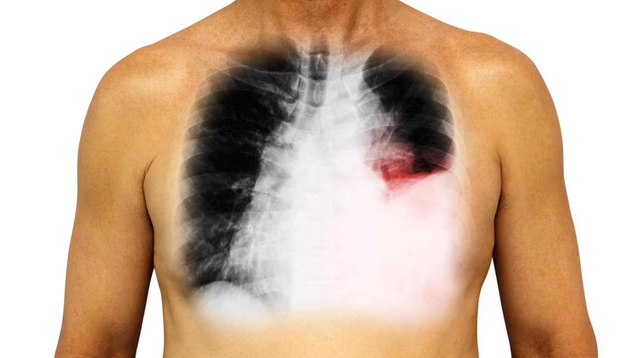 Understanding Pleural Effusion: Types, causes, symptoms, diagnosis and ...