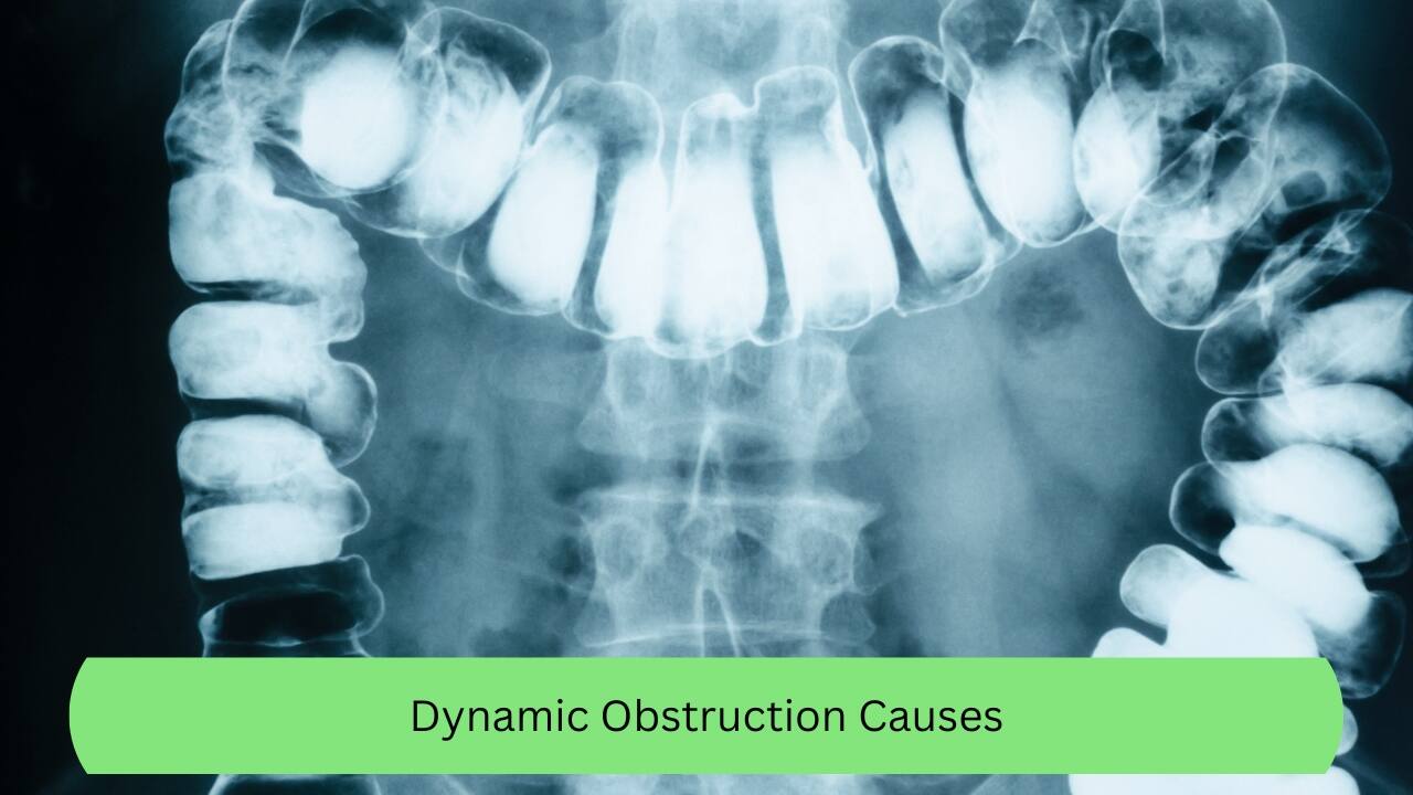 All You Need to Know About Intestinal Obstruction | Moneycontrol News