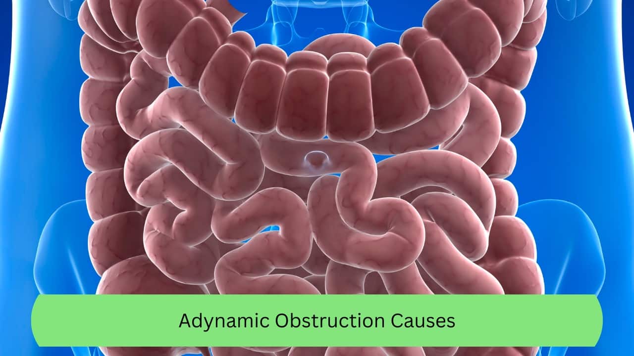 All You Need to Know About Intestinal Obstruction | Moneycontrol News