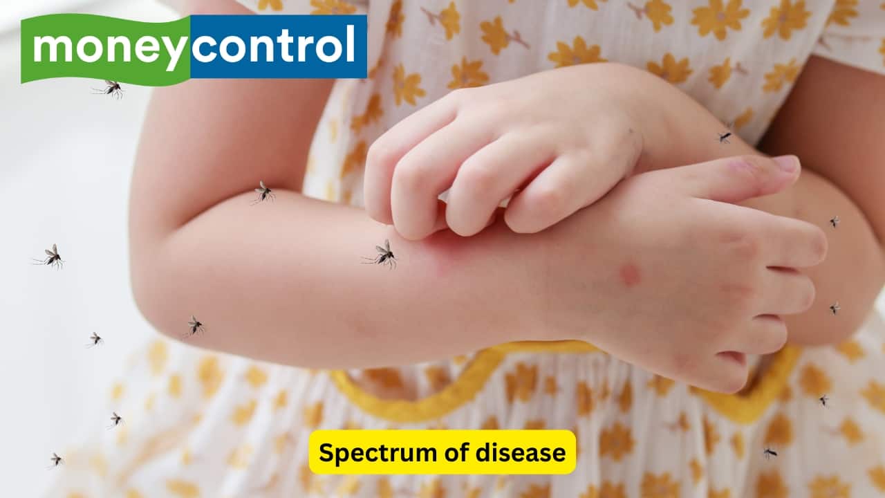 10 things about dengue: Causes, phases, and clinical features