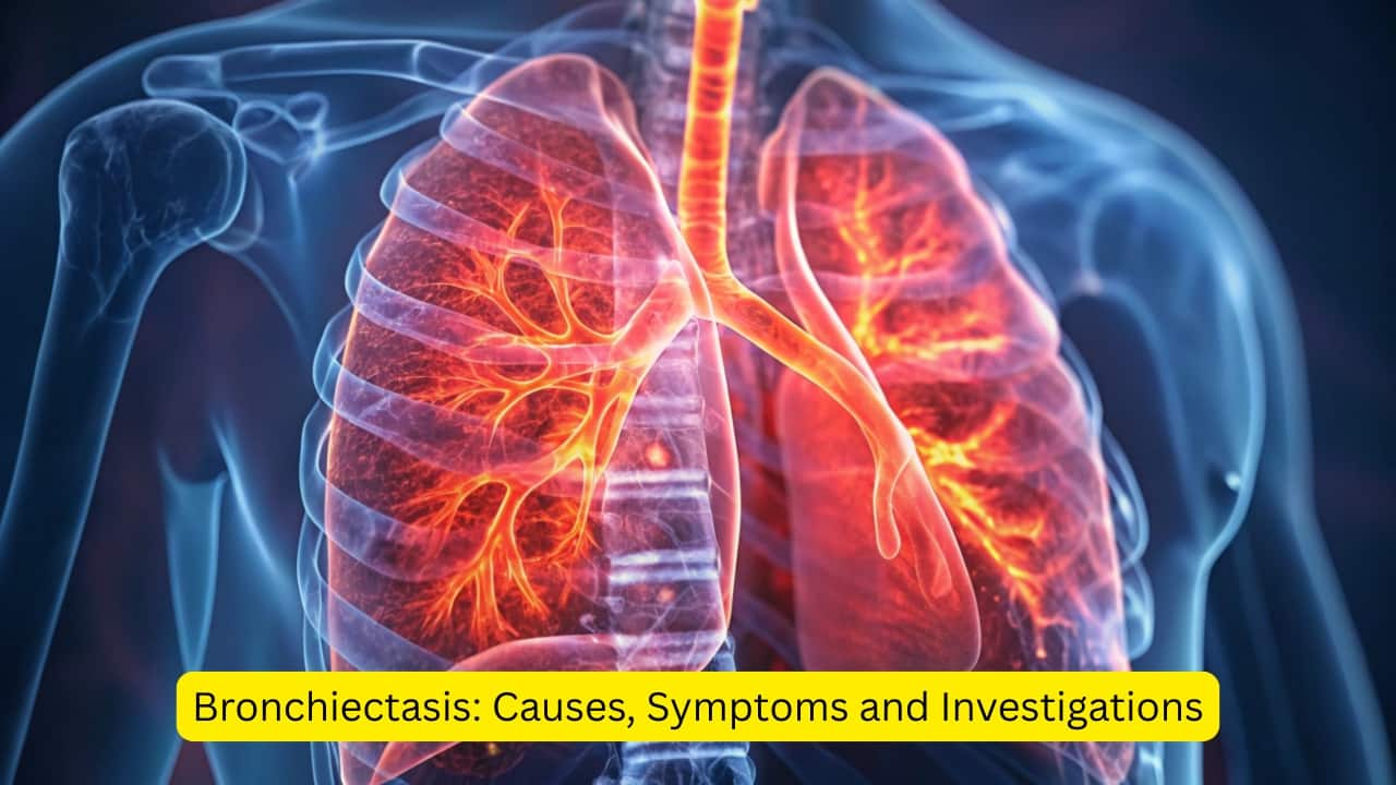 What is Bronchiectasis? Symptoms, causes and treatment you should know
