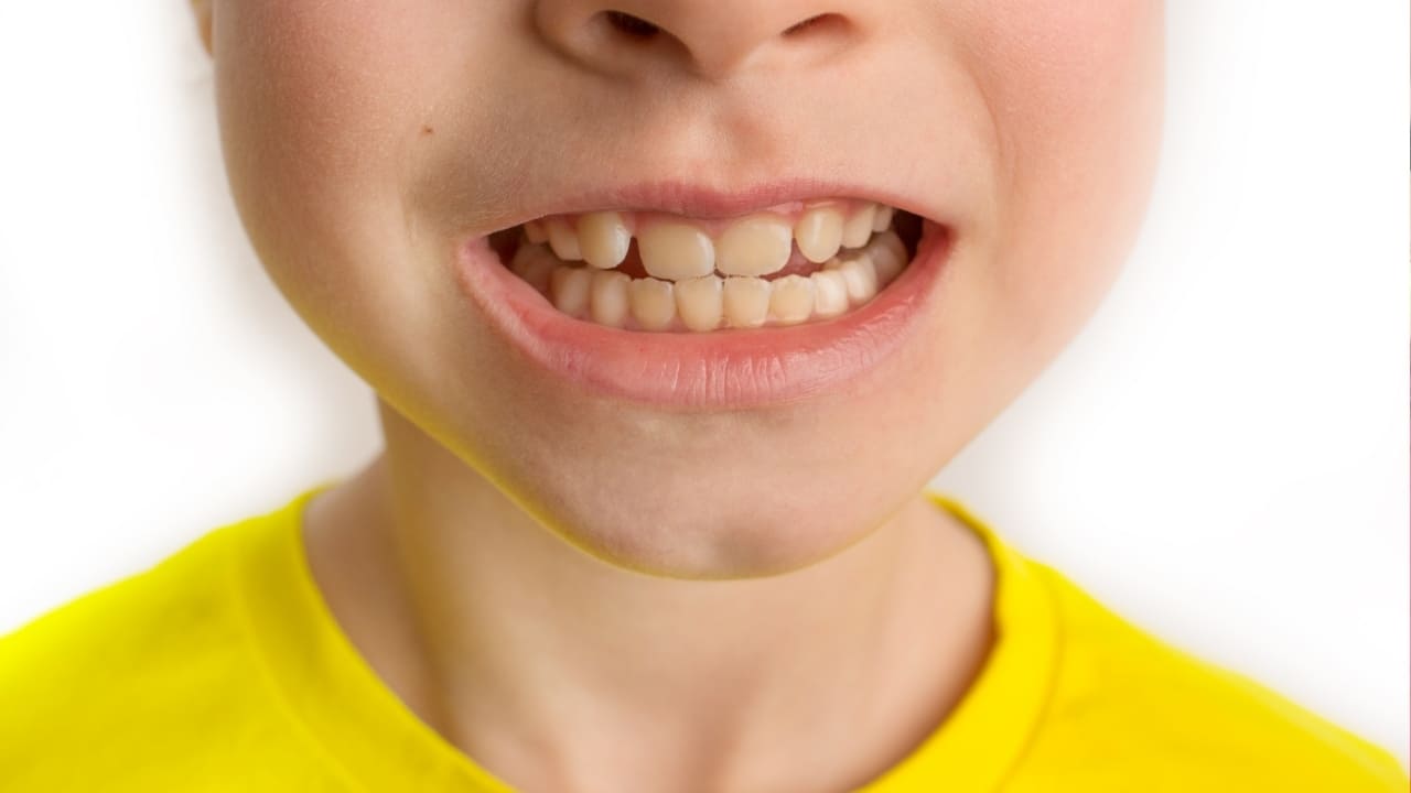 Causes of yellow teeth in children: Paediatric dentist warns against ...