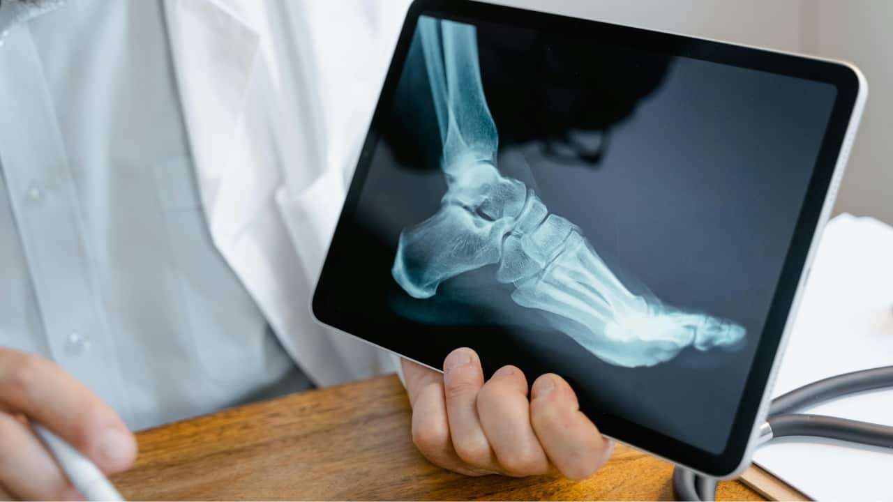 Weak bones, sudden fractures could be hidden symptoms of cancer in ...