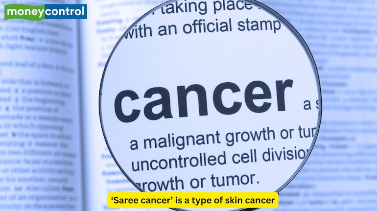 What is 'saree cancer'? A rare condition caused by the way women tie ...