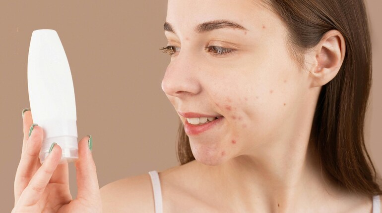 What is hormonal acne? Dermatologist explains 4 causes