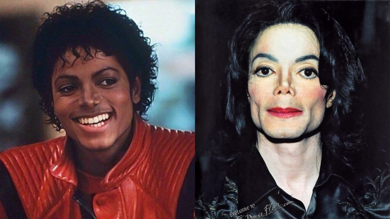 Michael Jackson had vitiligo; investigators found multiple skin ...