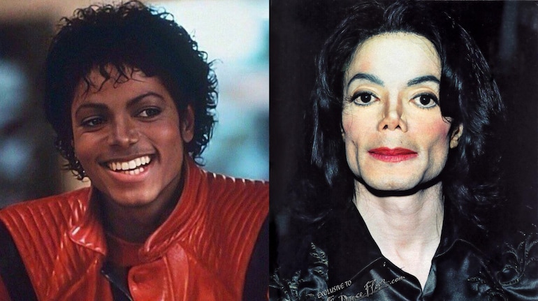 Michael Jackson had vitiligo; investigators found multiple skin ...