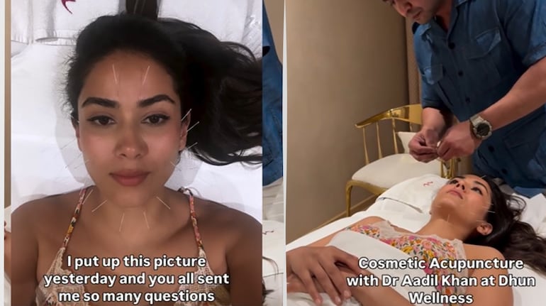 Mira Rajput swears by cosmetic acupuncture, expert says it promotes ...