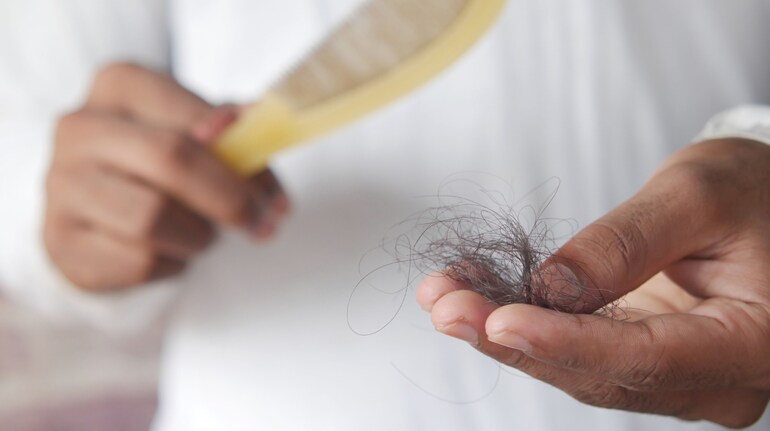 Rapid weight loss can lead to sagging skin and trigger hair fall, warns ...